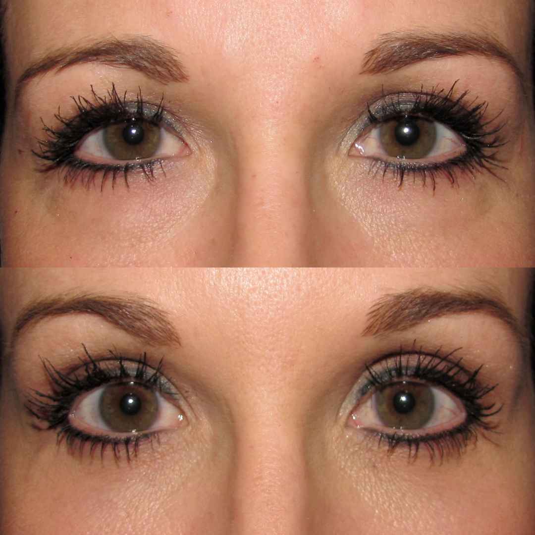 Lower Eyelid Blepharoplasty: Restore Your Youthful Glow