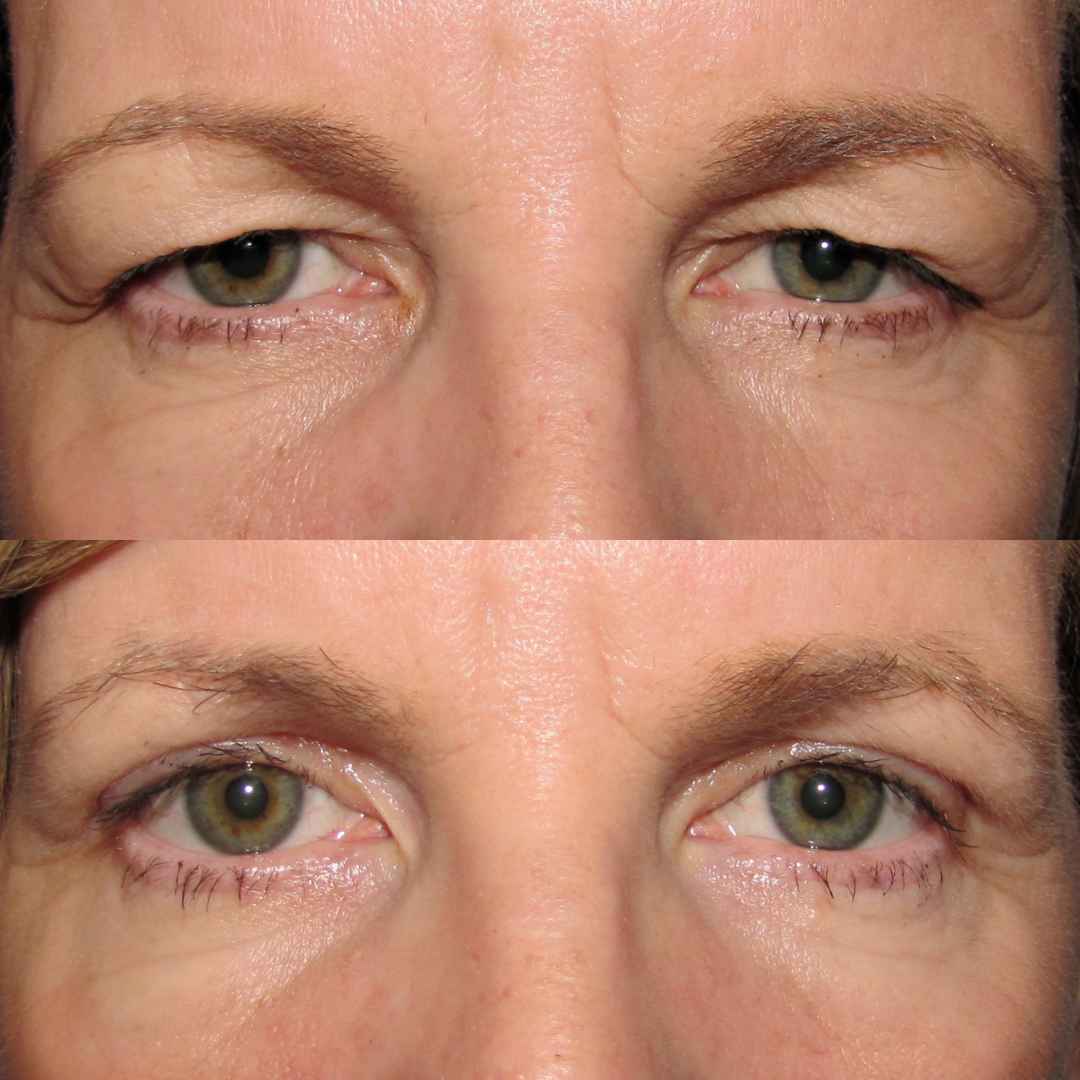 Upper Eyelid Blepharoplasty And Ptosis Repair Modern Aesthetic ...